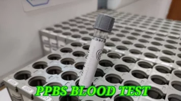 Ppbs Blood Test কি এবং কেন করা হয়? সতর্কতা,প্রস্তুতি ও খরচ কত? | PPBS ...