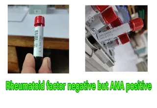 Rheumatoid Factor Negative But ANA Positive || Positive Rheumatoid Factor Negative Ana ...