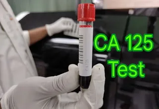 Why CA125 Test Is Done? Test Preparation, Sample Collection, Report ...