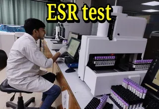 Why ESR Is High In Female? - OviggoBD.com